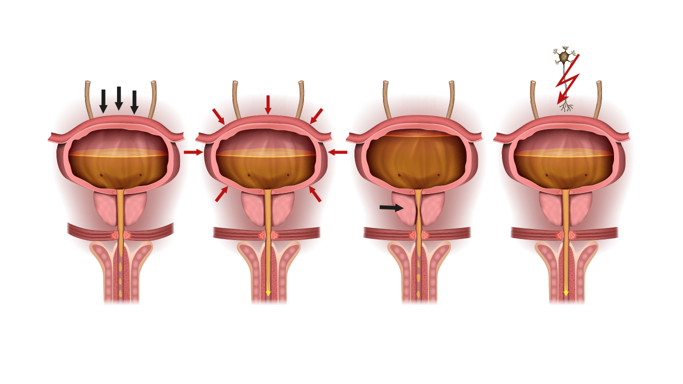 Overflow Incontinence – Symptoms - Wellspect